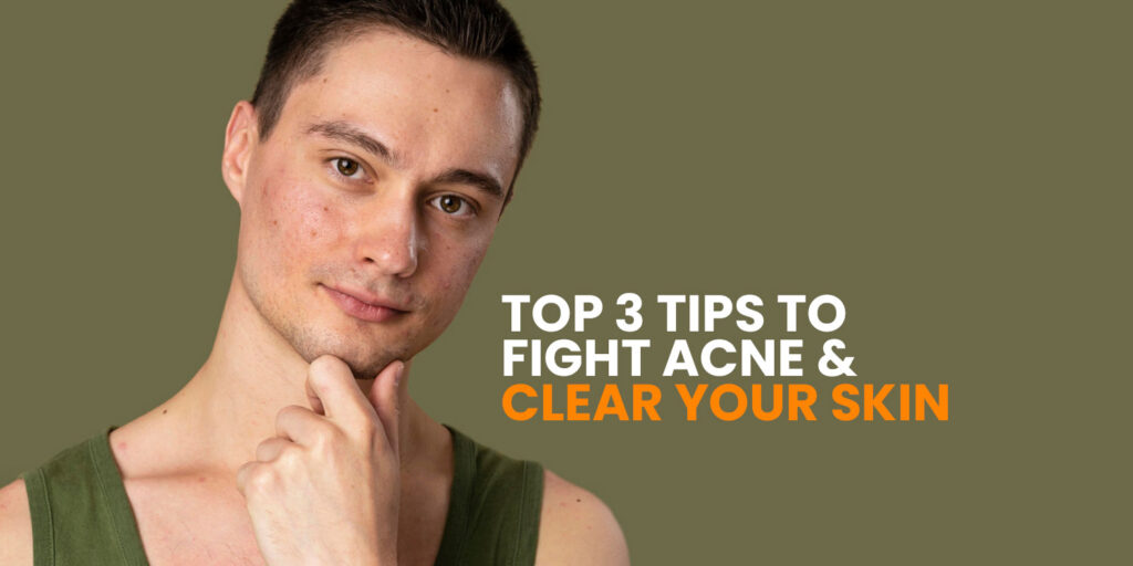 Top 3 Tips to Fight Acne and Clear Your Skin | iCare Pharmacy